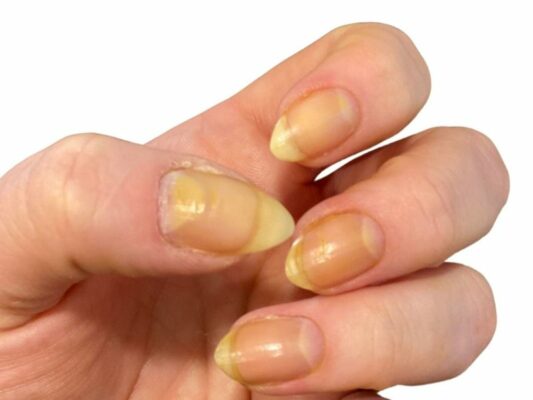 5 Possible Causes Of Yellow Nails, According To Dermatologists